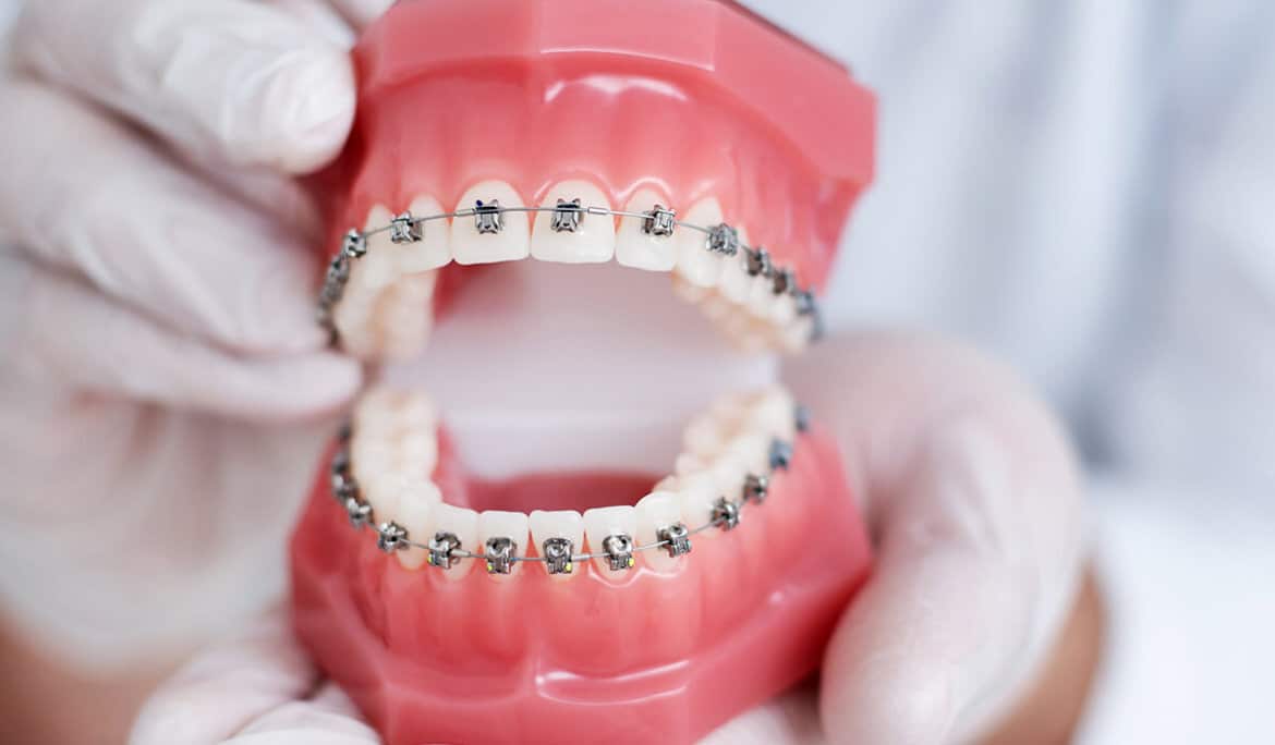 Overbite: A Complete Guide By An Orthodontist - Orthodontic Experts