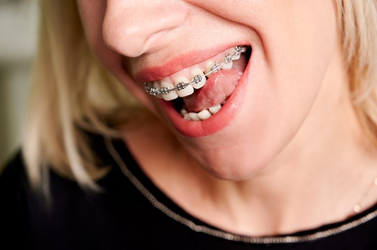 Using Spacers for Braces: What You Need to Know