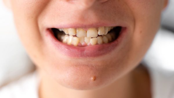 Signs You Need Orthodontic Treatment | Common Conditions