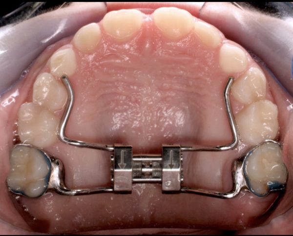 Orthodontic Appliances - Braces and Clear Aligners