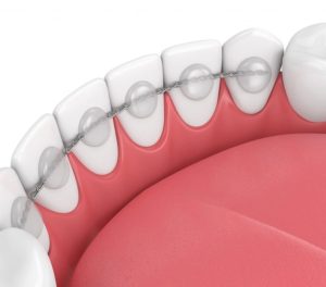 A Permanent Retainer for Permanent Smile | Pros, Cons and Cost