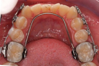 Orthodontic Appliances - Braces and Clear Aligners