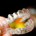 Vivera Retainers | Benefits of Vivera Retainers & Cost