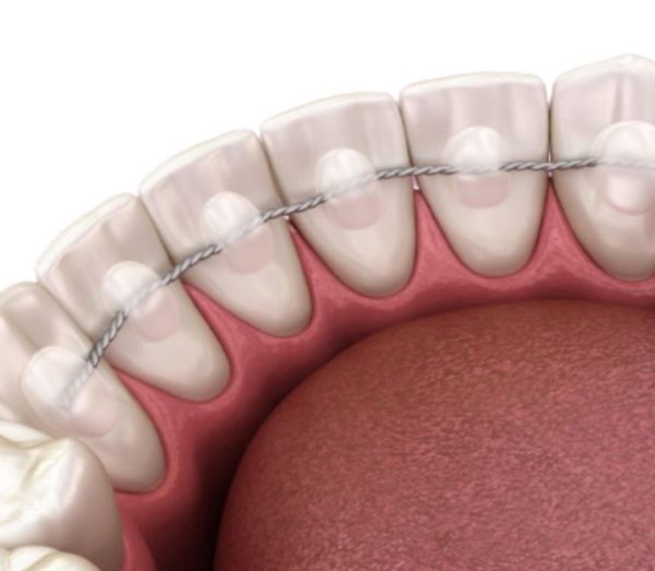 Bonded Retainer Keeps Your Teeth in Their New Place