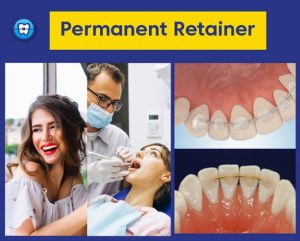 A Permanent Retainer for Permanent Smile | Pros, Cons and Cost