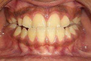 Under Bite: Causes, Effects, and Corrective Treatments