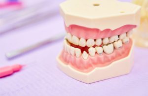Under Bite: Causes, Effects, and Corrective Treatments