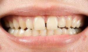 Spacing Problems: Treating Gaps Between Teeth