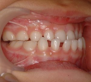 Under Bite: Causes, Effects, and Corrective Treatments