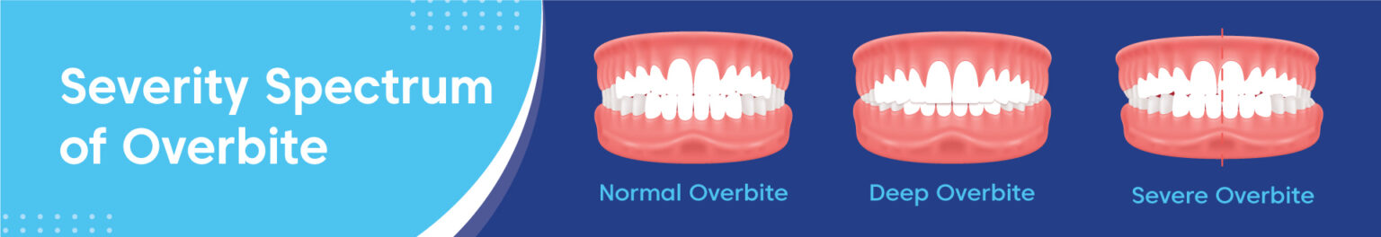 Overbite Correction: Can Braces Fix an Overbite?