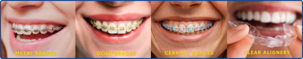 Cost Of Orthodontic Treatment | Orthodontic Experts